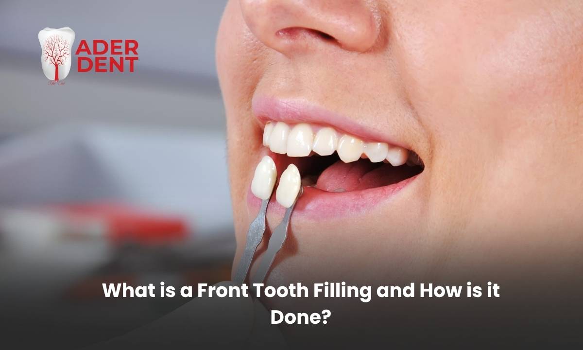 What is a Front Tooth Filling and How is it Done?